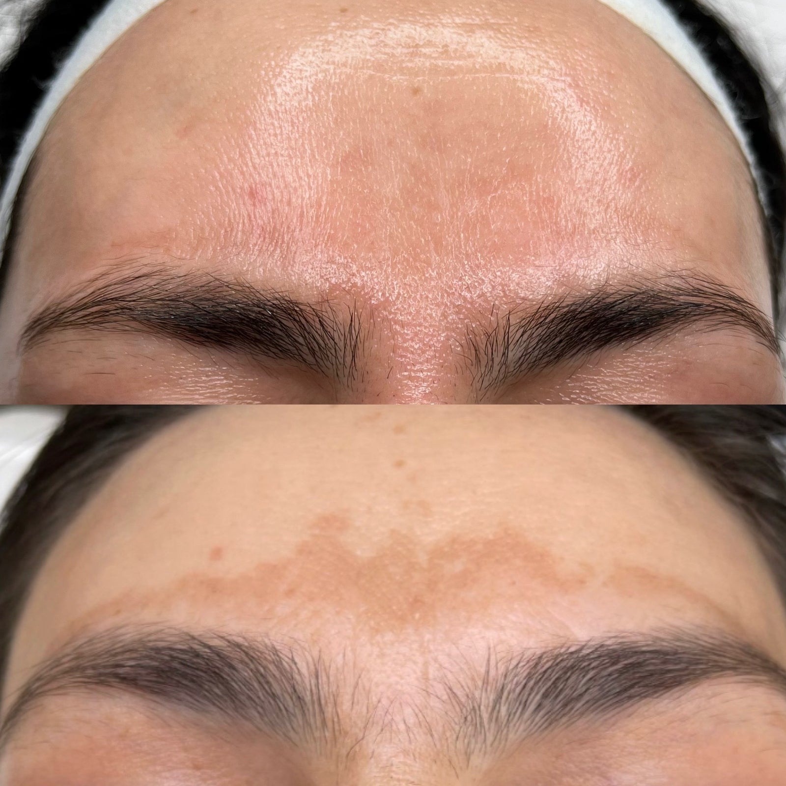 Cosmelan & Dermamelan Treatment at Silk Space Clinic | Transform Your Skin